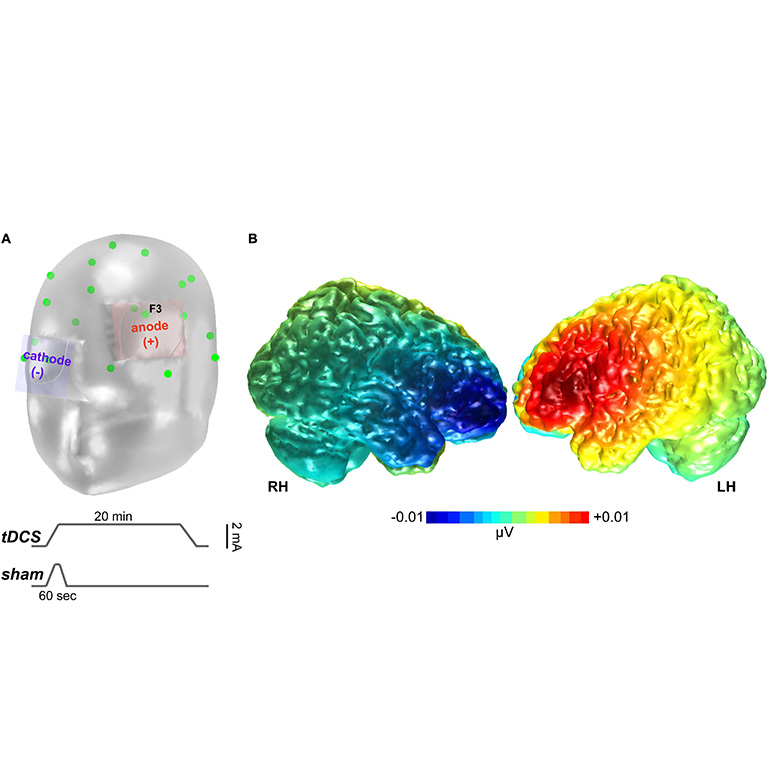 Transcranial direct current stimulation (tDCS) combined with listening ...